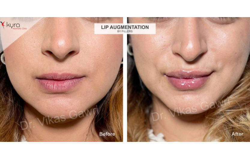 Expert Lip Augmentation Surgery In Ludhiana Punjab India